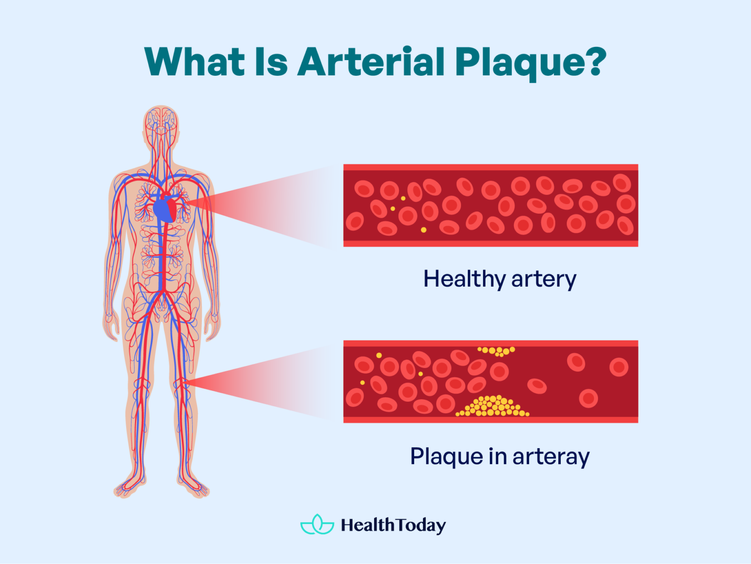 How to Reduce Plaque in Arteries? Vascular Cleansing Naturally