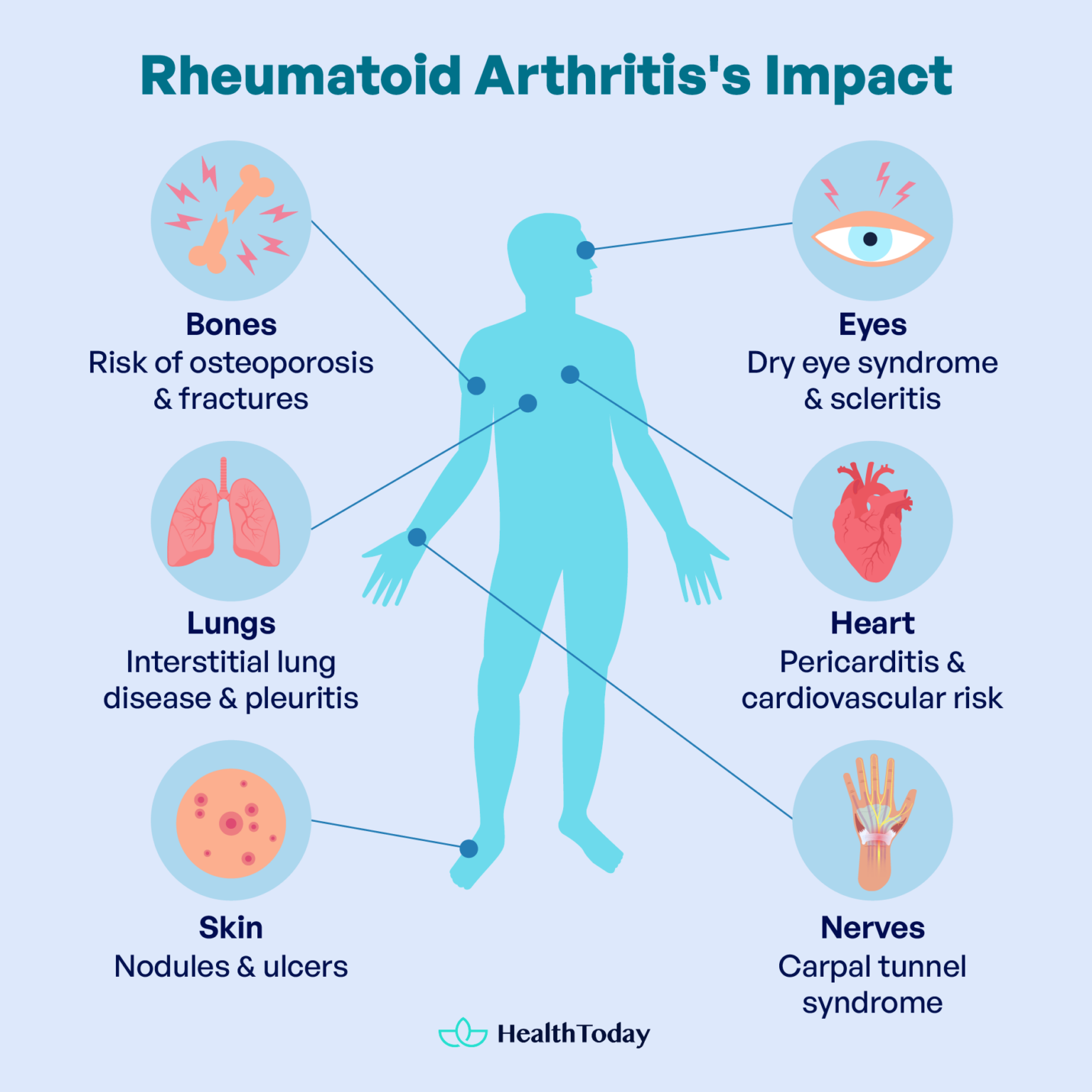 Symptoms and Long Term Effects of Rheumatoid Arthritis - HealthToday