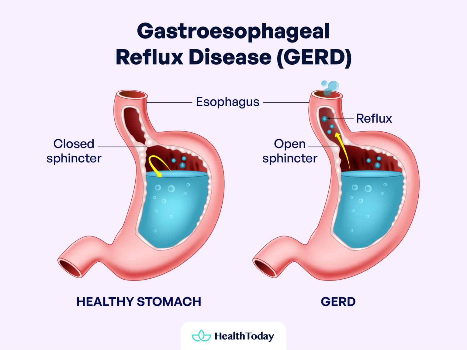 What Foods Give You Heartburn? Foods to Relieve Heartburn - HealthToday