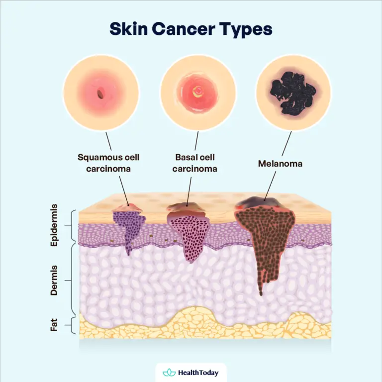 Can You Die From Skin Cancer? Survival Rates and Preventions - HealthToday