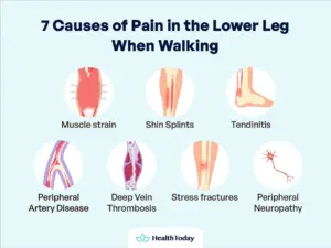 7 Causes of Lower Leg Pain When Walking, Symptoms, and Treatments ...