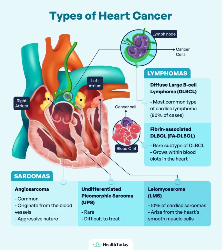 Is There Heart Cancer? Types, Symptoms, Treatments - HealthToday
