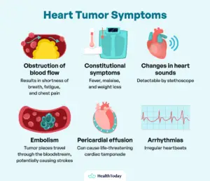 Is There Heart Cancer? Types, Symptoms, Treatments - HealthToday