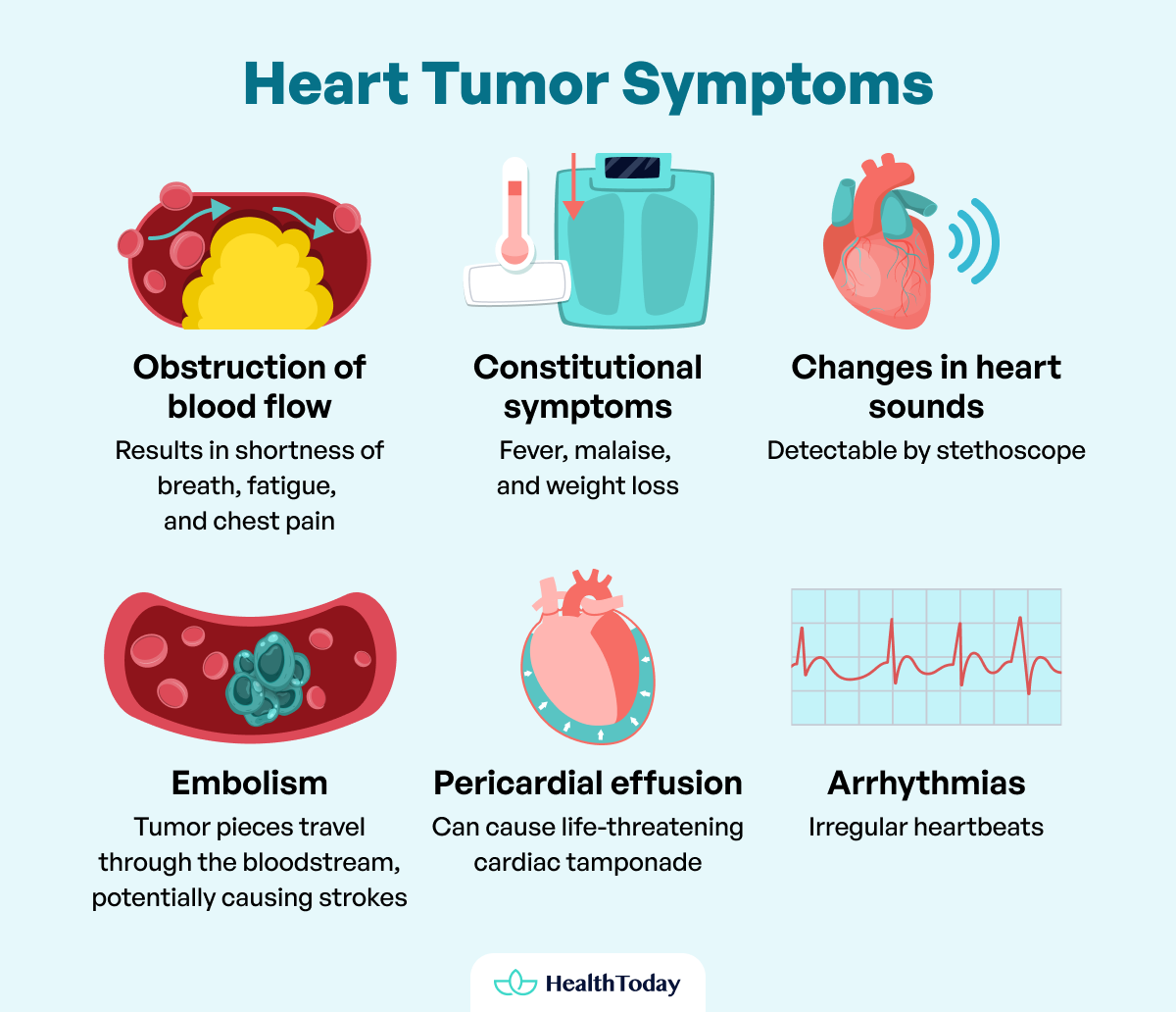Is There Heart Cancer? Types, Symptoms, Treatments - HealthToday