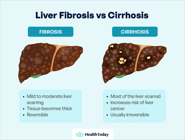 What Is Liver Fibrosis: Causes, Symptoms, Stages and More - HealthToday